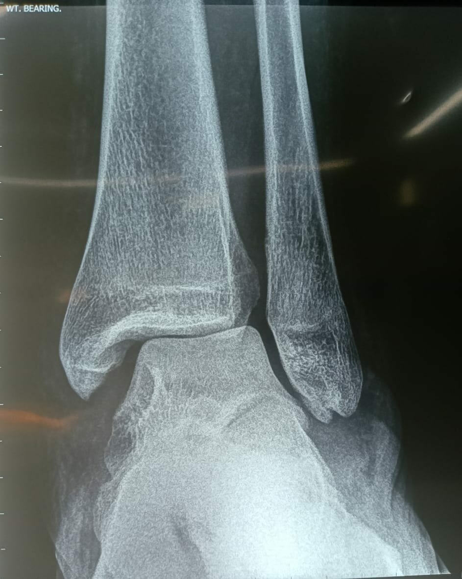 Foot ball injury causing complex syndesmosis ligament injury treated by ...