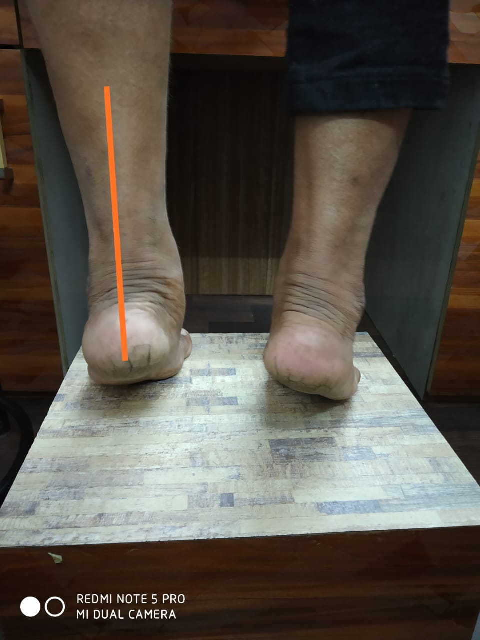 Flat foot deformity | Suyog Hospital