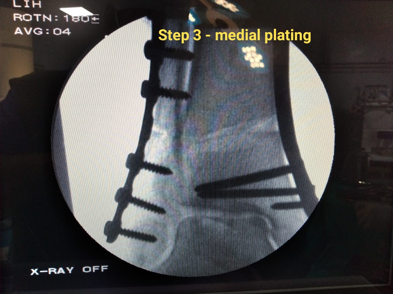 How do we correct ankle deformity, chronic ankle instability and early ...