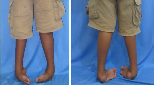 Correcting Recurrent Rigid Clubfoot Deformity with Surgical Expertise ...
